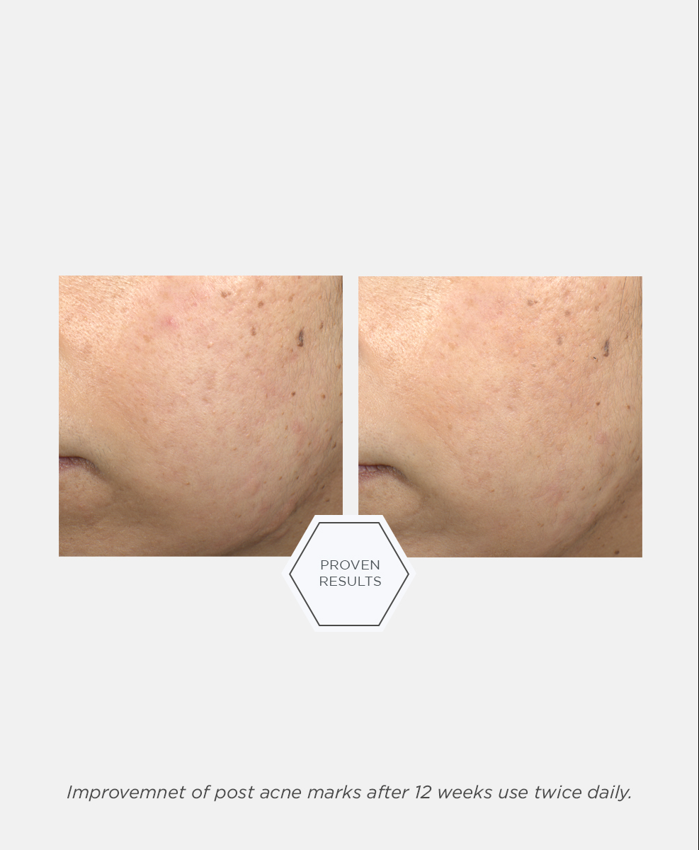 Neostrata Post Acne Mark Correcting Serum Aknearpiseerumi 30 Ml